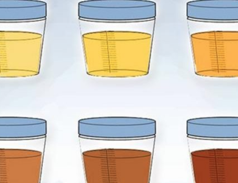 D'Estate attenti al colore della vostra pipì: Ecco quando preoccuparsi ...